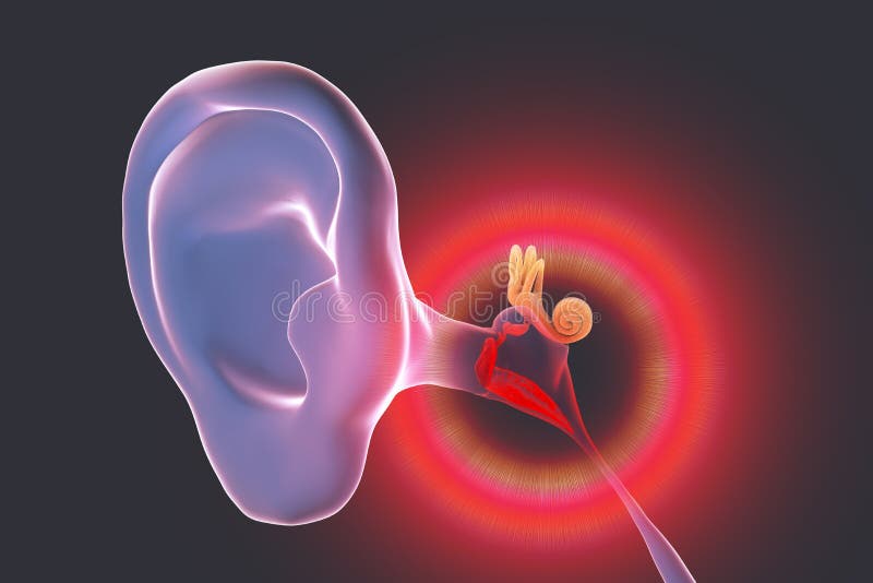 Otitis media, illustration stock illustration. Illustration of hear ...
