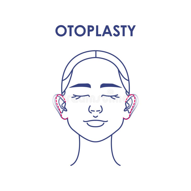 Otoplasty Stock Illustrations – 470 Otoplasty Stock Illustrations ...