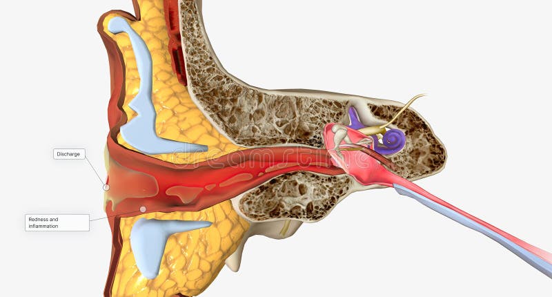 An Outer Ear Infection, Also Called Otitis Externa Stock Illustration ...