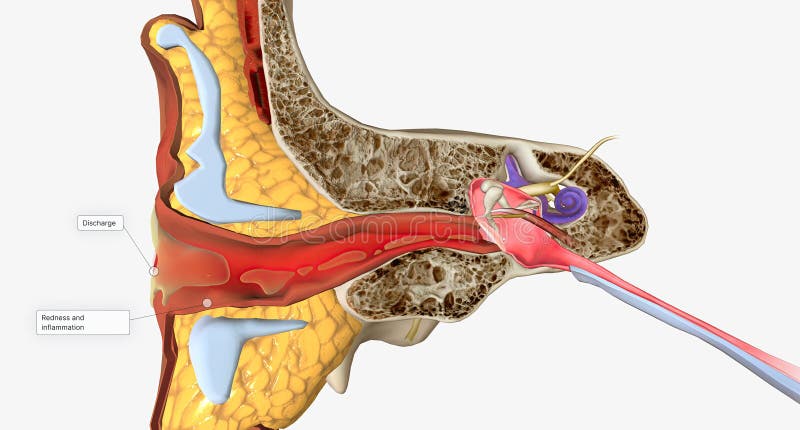 An Outer Ear Infection, Also Called Otitis Externa Stock Illustration ...