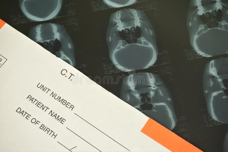 Close Up of CT Scan Films of Skull and Packaging Stock Photo - Image of ...