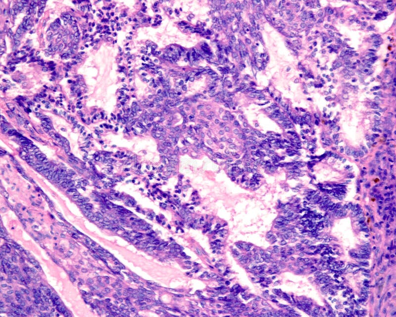 Most Common Cancer Epithelial Tissue Stock Photos - Free & Royalty-Free ...