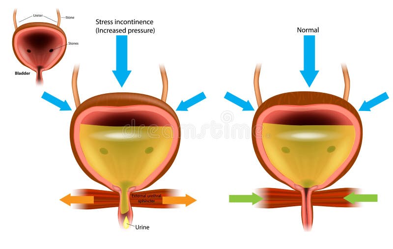 Overactive Bladder OAB and Normal Bladder.Illustration Showing Detrusor ...