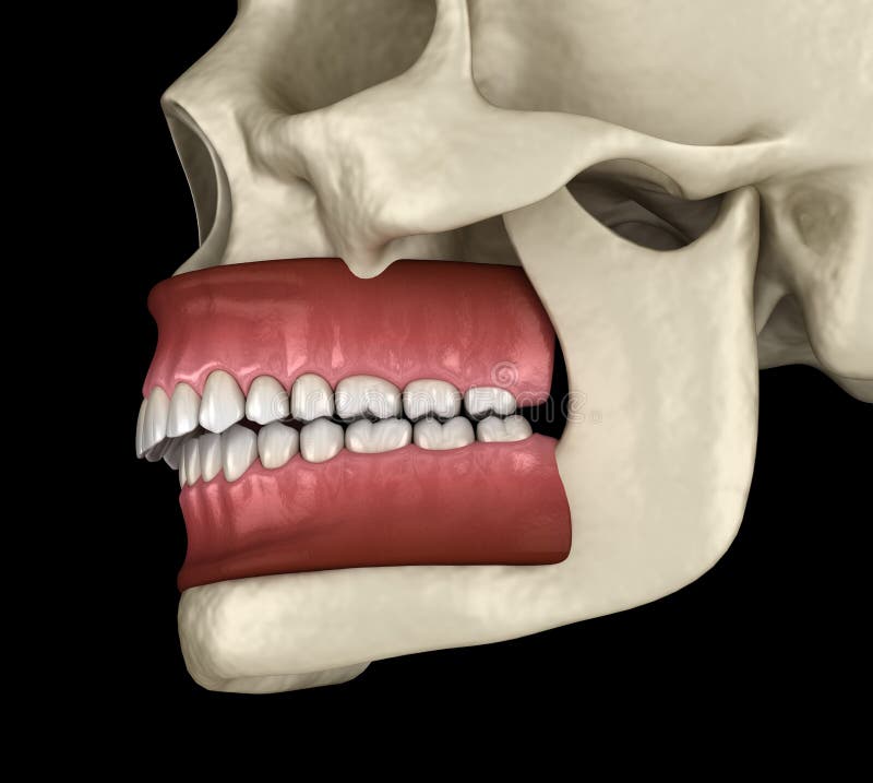 Overbite Dental Occlusion Malocclusion of Teeth . Medically Accurate ...