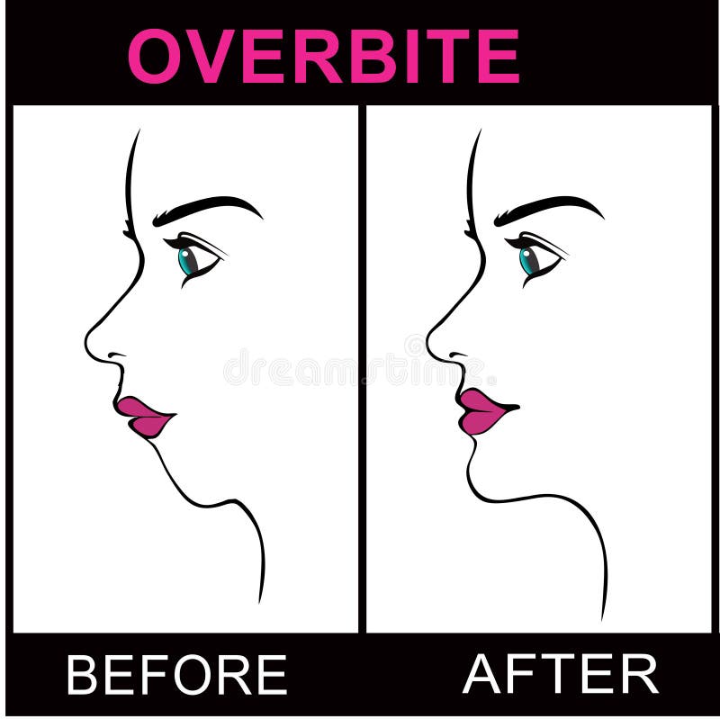 Overbite Stock Illustrations – 116 Overbite Stock Illustrations ...