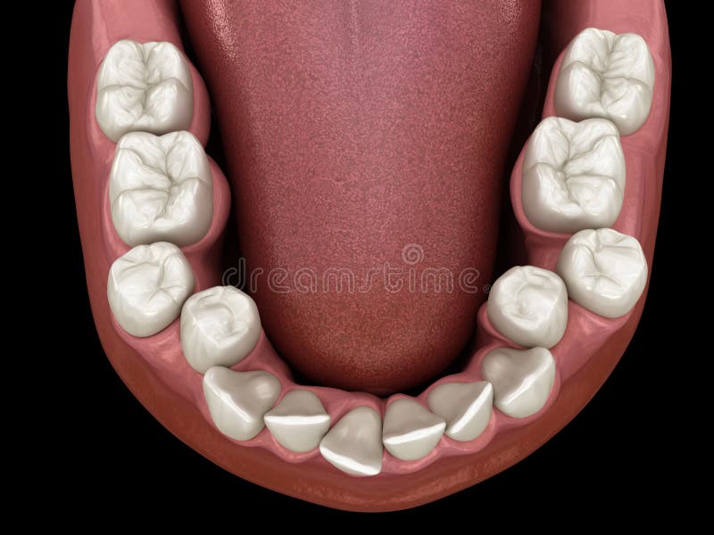 Overcrowded Teeth, Abnormal Dental Occlusion. Medically Accurate Tooth ...
