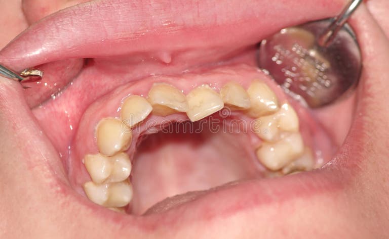 Overcrowding of the teeth stock image. Image of teething - 49627949