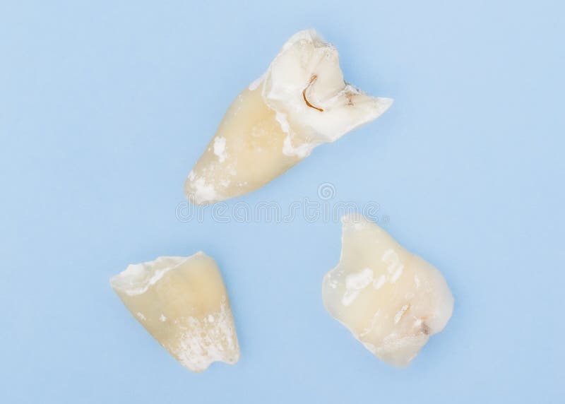 Pulled Molar Tooth with Gold Crown To Show Many Angle, Advanced Caries ...