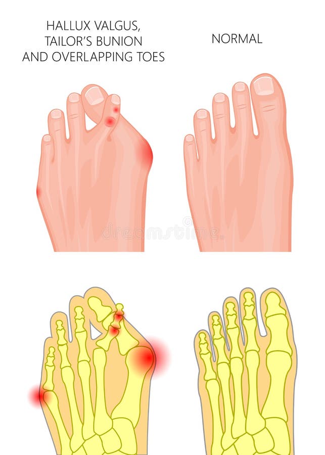 Overlapping toes stock vector. Illustration of deviation - 75016118