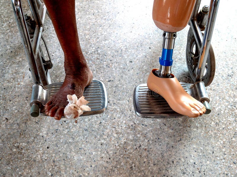 Pé amputado imagem de stock. Imagem de orthopedic, ferida - 56203439