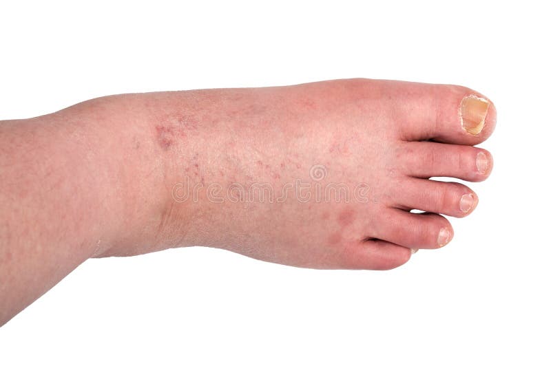 Pé inchado com fungos foto de stock. Imagem de médico - 28291144