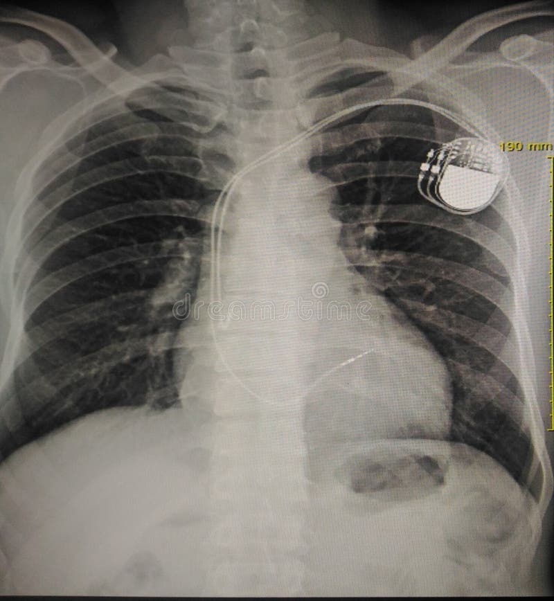 Pacemaker stock photo. Image of white, human, injury - 104363542