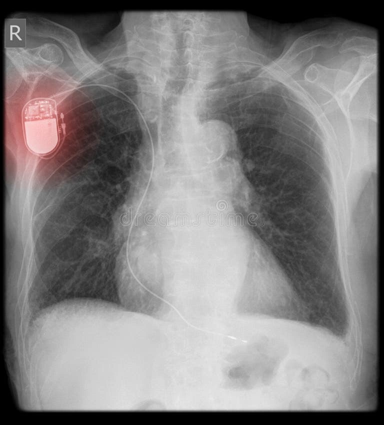 305 Pacemaker Woman Stock Photos - Free & Royalty-Free Stock Photos ...