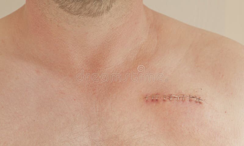 Heart Surgery Scar