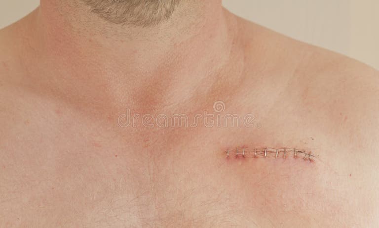 Pacemaker scar stock photo. Image of conditions, implant - 31037390