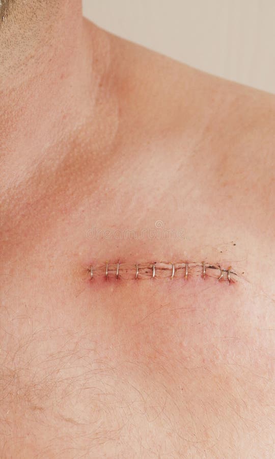 Pacemaker scar stock image. Image of arrhythmia, male - 31383145