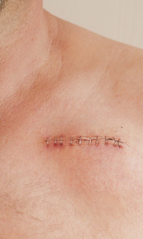 Pacemaker scar stock image. Image of arrhythmia, male - 31383145