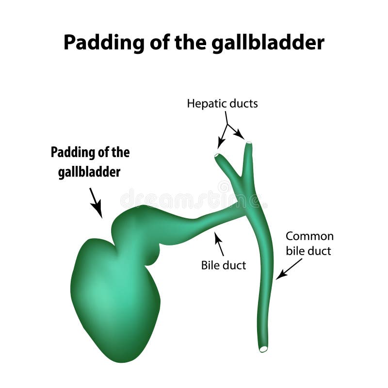 Padding of the Gallbladder. Pathology of the Gallbladder. Cholecystitis ...