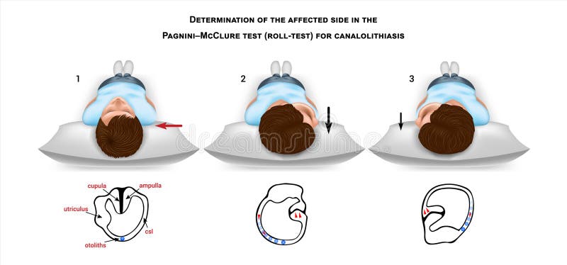 Pagnini McClure Roll Test for Canalolithiasis Vector Stock Vector ...