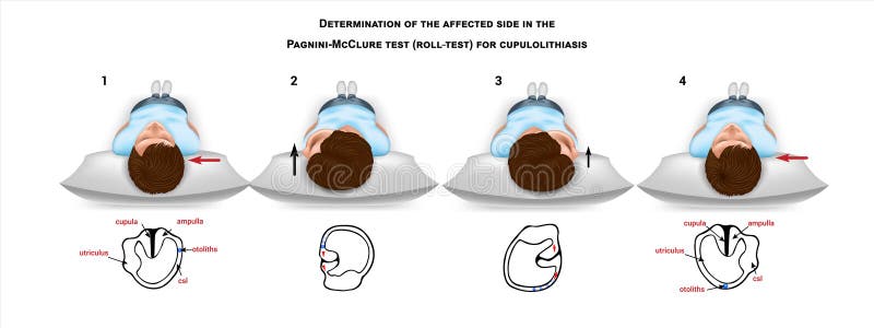 Pagnini McClure Roll Test for Cupulolithiasis Vector Stock Vector ...
