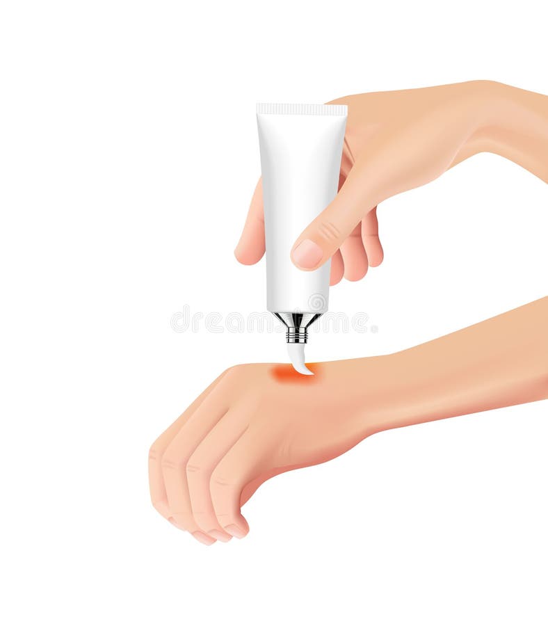 Skin Burn Injury Treatment. First Aid for Burn Wound Vector ...