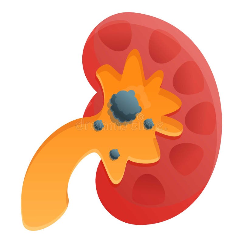 Kidney Stone Icon Stock Illustrations – 232 Kidney Stone Icon Stock ...