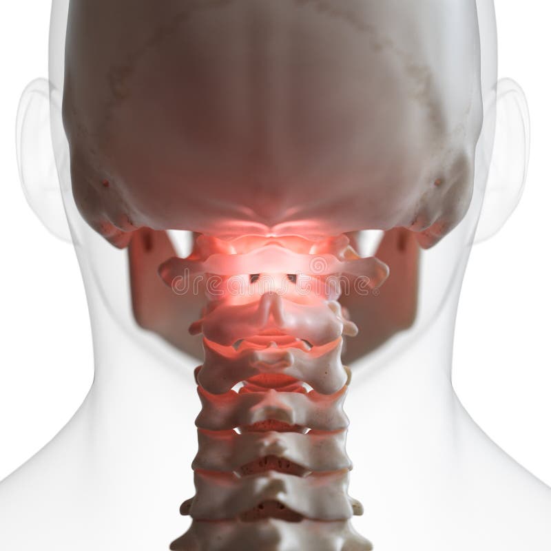 A painful atlas bone stock illustration. Illustration of arthrosis ...