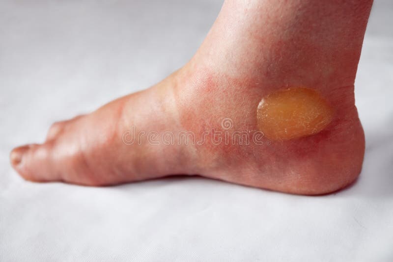 Painful Blister on the Burnt Foot Stock Photo - Image of skin, copy ...