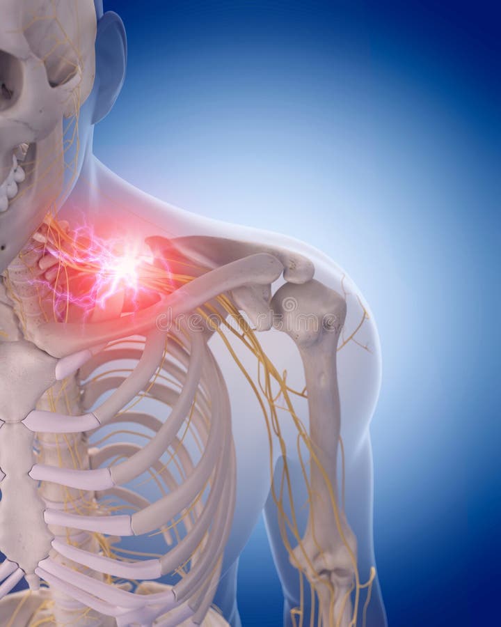 Painful cervical nerves stock illustration. Illustration of pain - 58775915