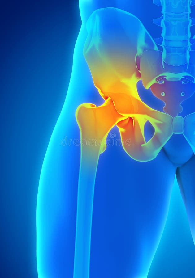 Painful Hip Joint stock illustration. Illustration of arthritis - 65731151