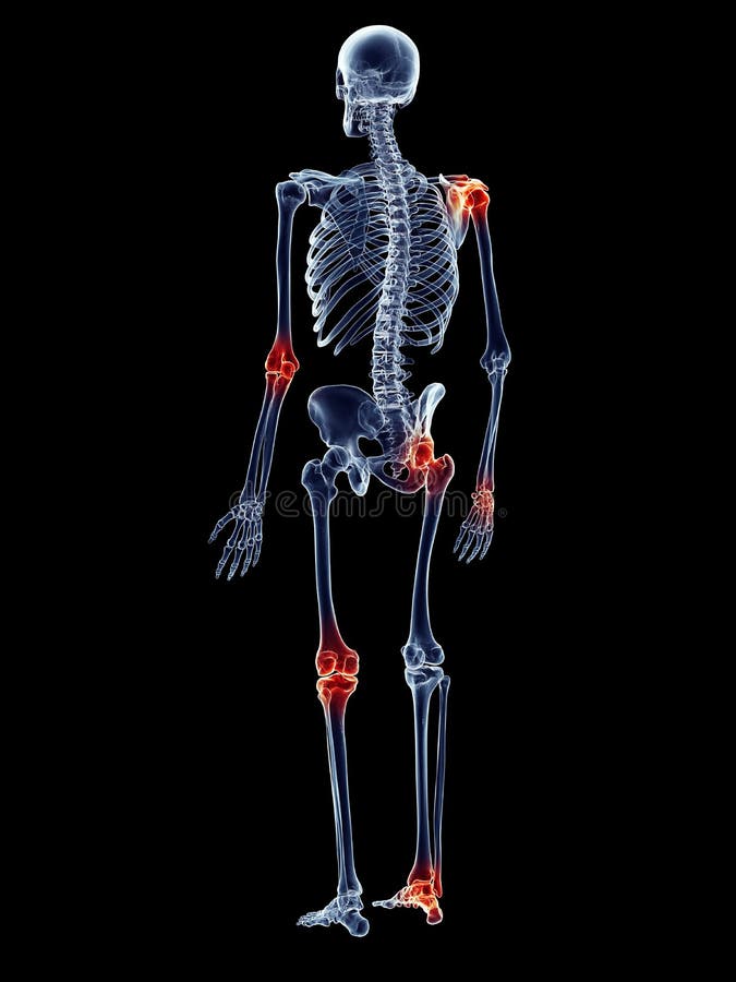 Painful joints stock illustration. Illustration of black - 57002328