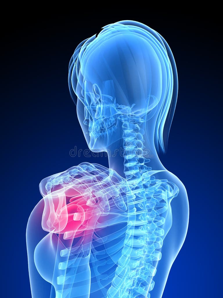 Woman Shoulder Pain Arthritis Stock Illustrations – 259 Woman Shoulder ...