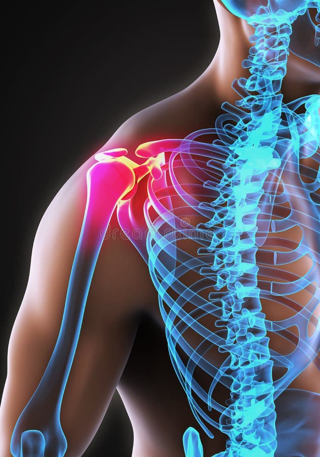 Painful Shoulder Illustration Stock Illustration - Illustration of ...