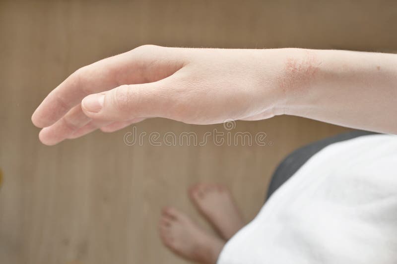 Painful Skin Condition with Redness, Flaking and Itching Stock Photo ...