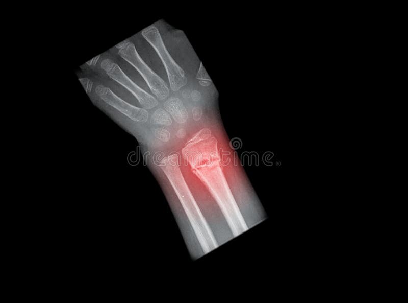 Broken Hand stock image. Image of recovery, orthopaedic - 21049313