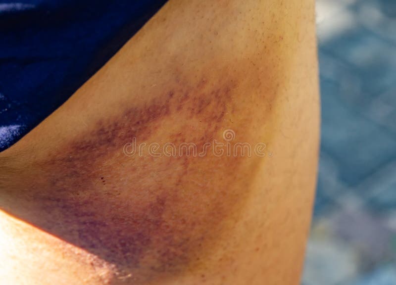 Painless Bruise on Thigh Trauma Stock Photo - Image of blow, thigh ...