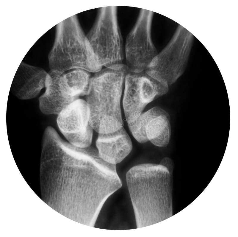 Human Hand Palm Mri Stock Photos - Free & Royalty-Free Stock Photos ...