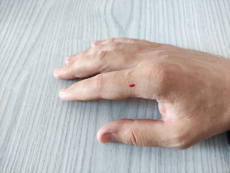 Palm of Hand with Bloody Scratch on the Table Stock Photo - Image of ...