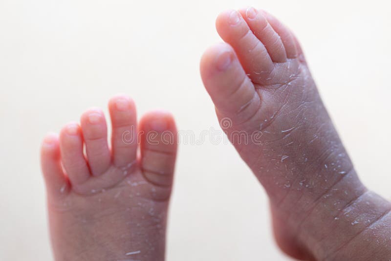 Palmoplantar Psoriasis and Atopic Dermatitis in Infants. Stock Photo ...