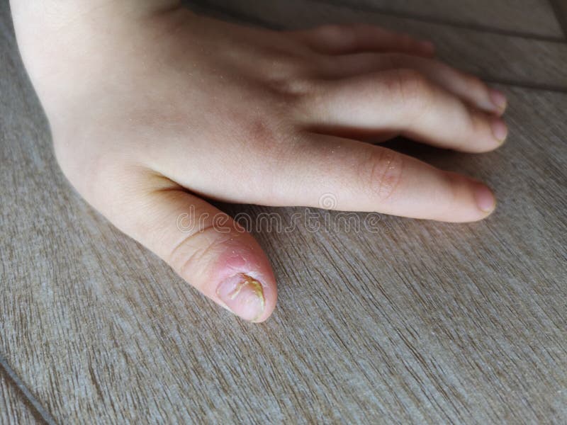 Panaritium a criança mal imagem de stock. Imagem de problema - 118842457