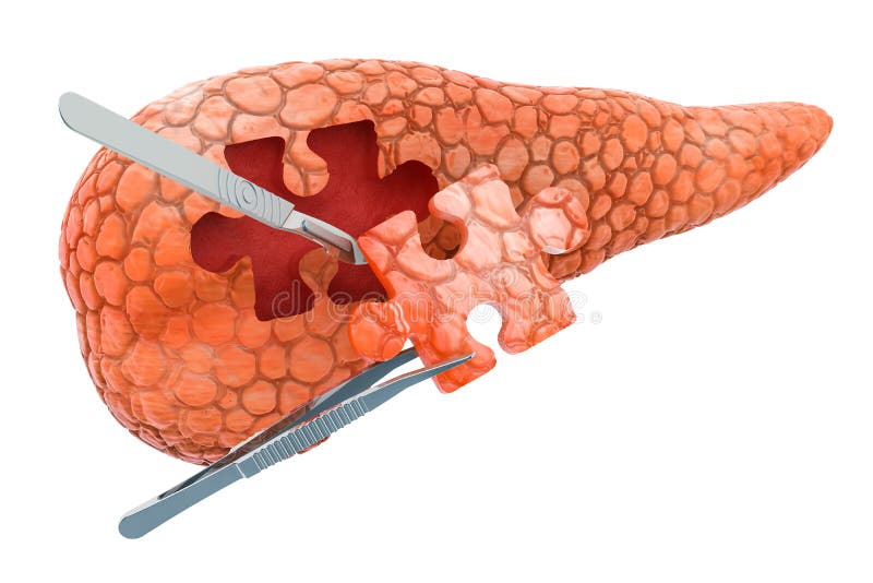 Pancreatic Surgery Concept, 3D Rendering Stock Illustration ...