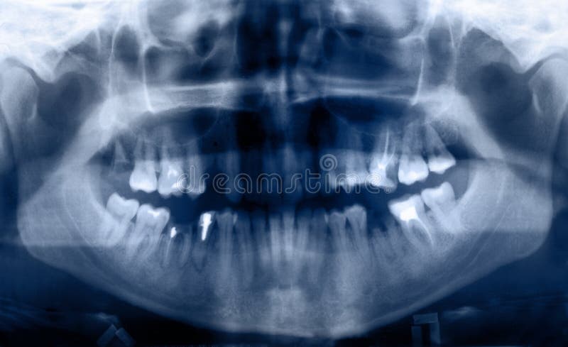 Panoramic Dental X-ray of Child Photo with Milk Teeth and First Molar ...
