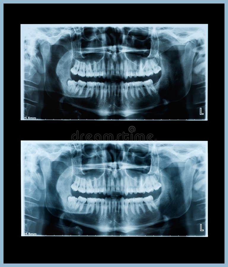Ray Teeth Granuloma Stock Photos - Free & Royalty-Free Stock Photos ...