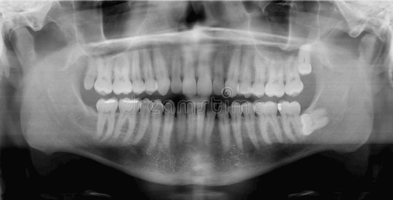 Panoramic Dental X-ray stock photo. Image of black, panoramic - 4599906