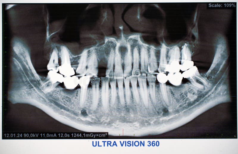 Panoramic Dental X-Ray with Broken Tooth Stock Image - Image of health ...