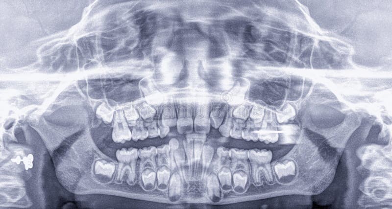 Panoramic Dental X-ray of Child Stock Image - Image of scan, parts ...