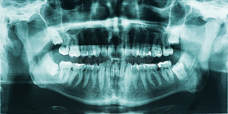 Panoramic Dental X-Ray stock image. Image of surgery - 46313747