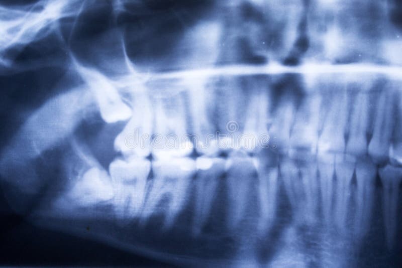 Panoramic Dental X-Ray of Human Teeth Stock Photo - Image of scan ...