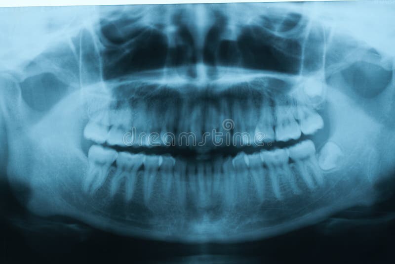 Fixed Appliance Brackets X-ray, Orthodontic Treatment Stock Image ...