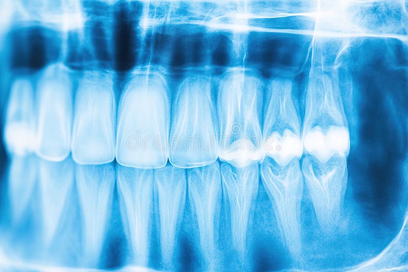 Panoramic Dental X Ray Showing Adult Teeth and Jaw Structure Stock ...